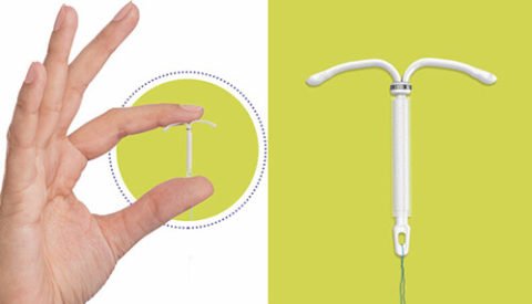 Kyleena, novo método contraceptivo - Dra. Renata Assef Tormena